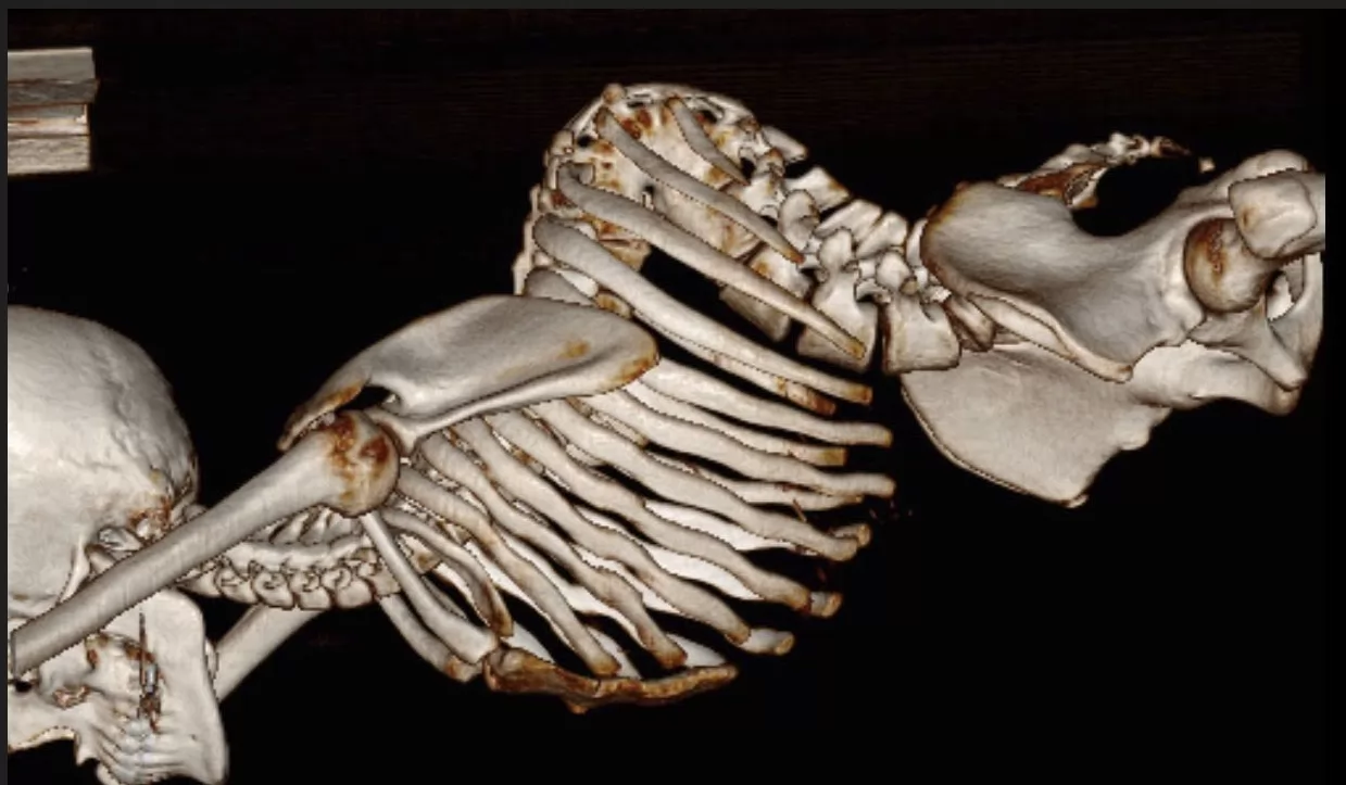 İleri Derece Omurga Eğriliklerinde Cerrahi Tedavisi